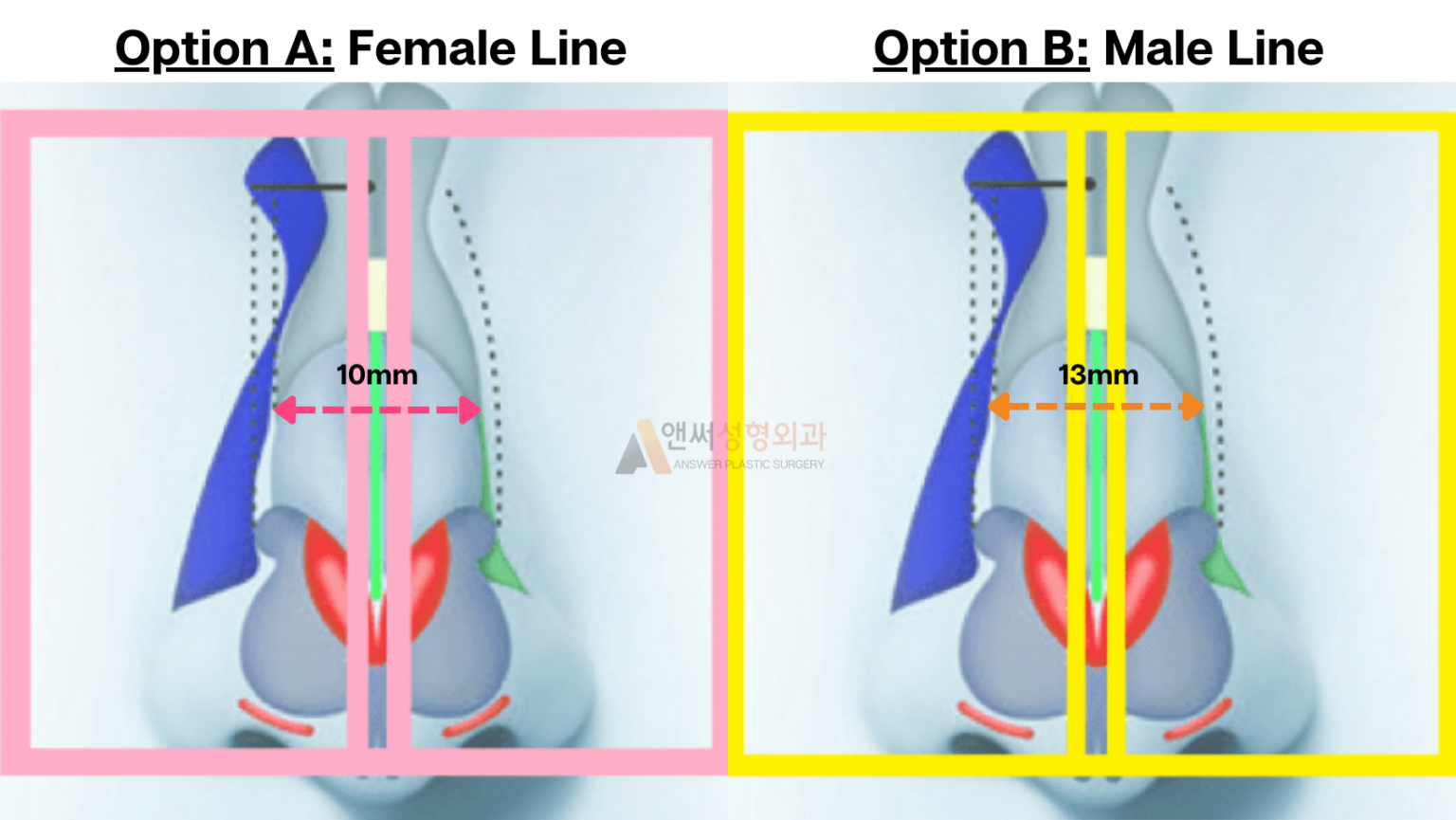Nose Bridge Correction and Augmentation | Answer Plastic Surgery